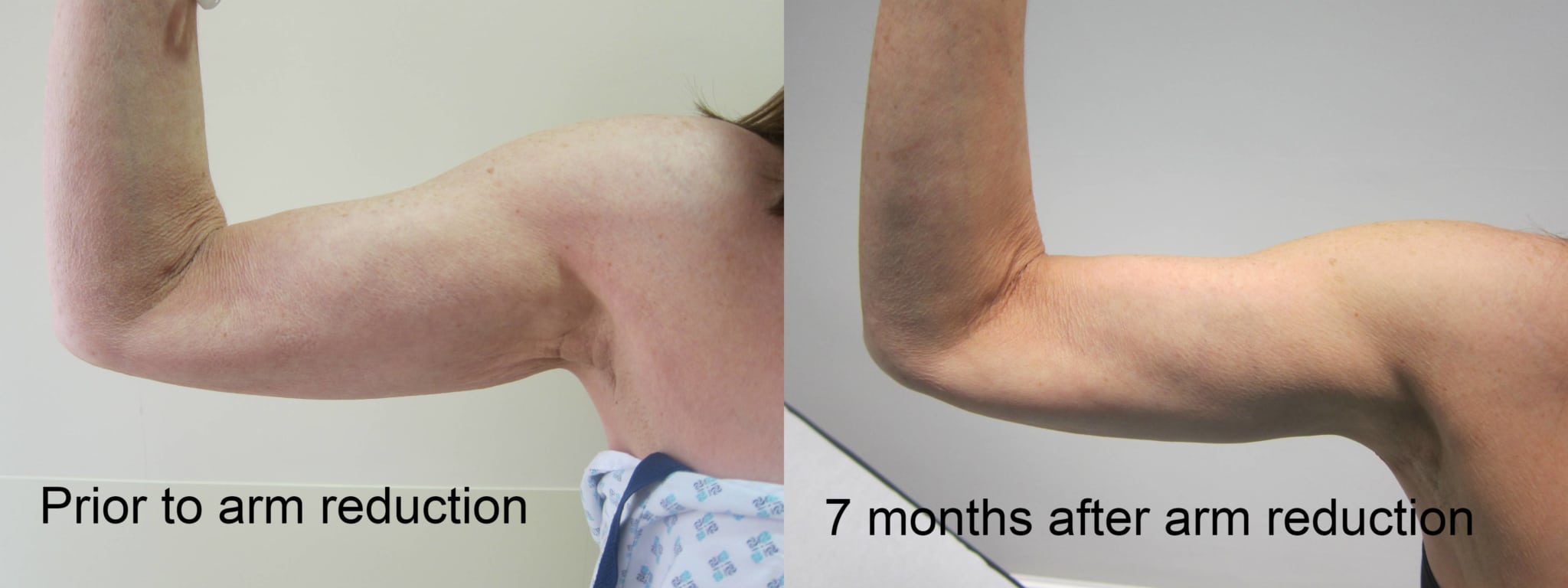 Arm Reduction Brachioplasty - Staiano Plastic Surgery