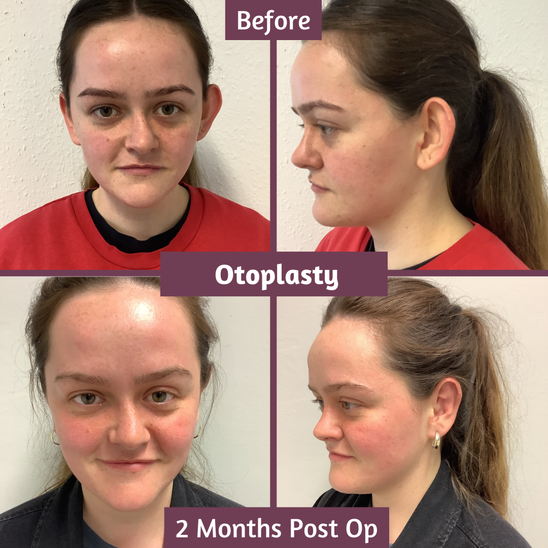 Otoplasty Done By Plastic Surgeons Under Local Anaesthetic,