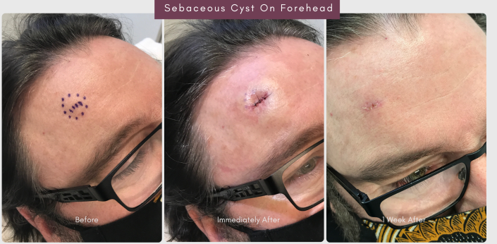 Understanding Sebaceous Cysts: Causes and Treatments