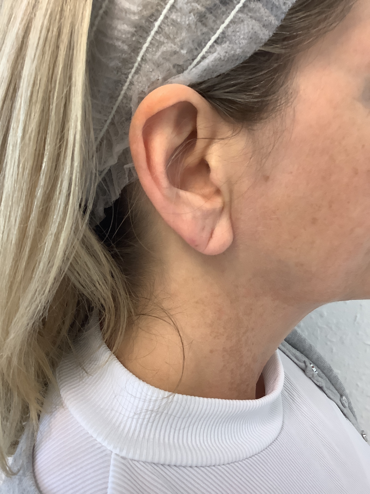 Where is the best place to get earlobe reduction near me?